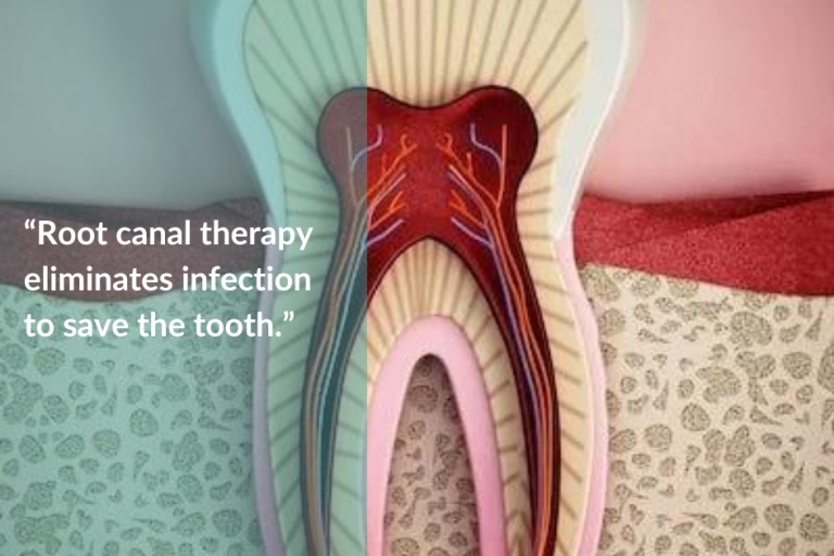 Best Root Canal in Pflugerville, TX - Comfortable Environment - Pecan ...